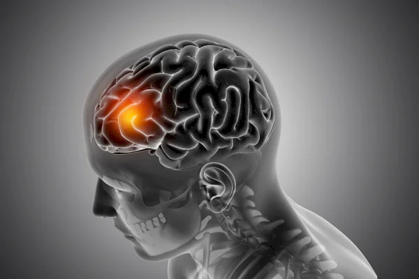 What are the types of brain tumors and what are their most prominent ...